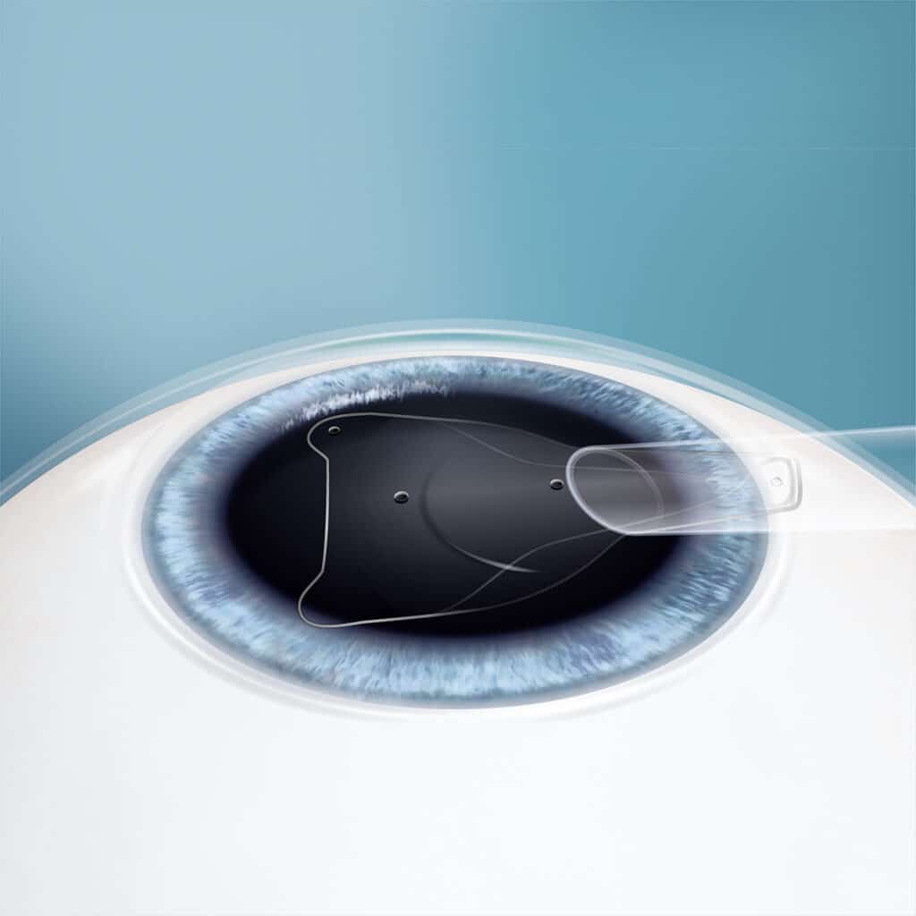 What is the EVO Visian ICL? | Manhattan LASIK Center