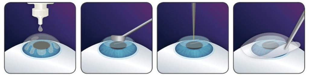 Post-Procedure Care Instructions | Manhattan LASIK Center New York, NY