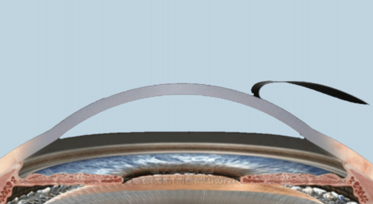 Bladeless LASIK in Manhattan NYC - Zeiss | Manhattan LASIK Center