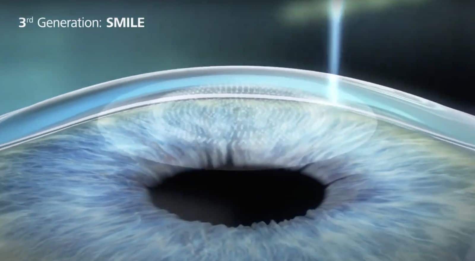 Post-Procedure Care Instructions | Manhattan LASIK Center New York, NY