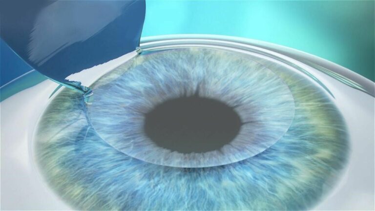 LASIK Eye Surgery New York | Manhattan LASIK Center NYC